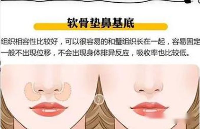 膨體填充鼻基底危害 - 生活 - iNewsDB 日日新聞．掌握每日新鮮事